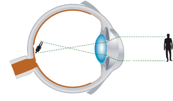 Astigmatism – IOL Expert
